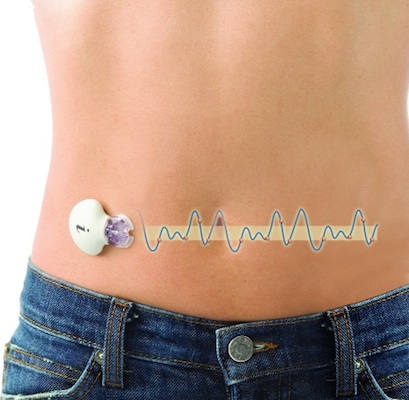 Medtronic 'iPro' | Diyabetimben.com