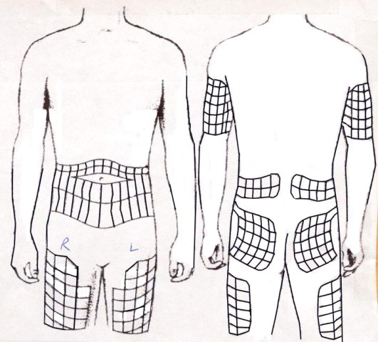 İnsülin Yapıyorum Ama Kan Şekerim Düşmüyor | Diyabetimben.com